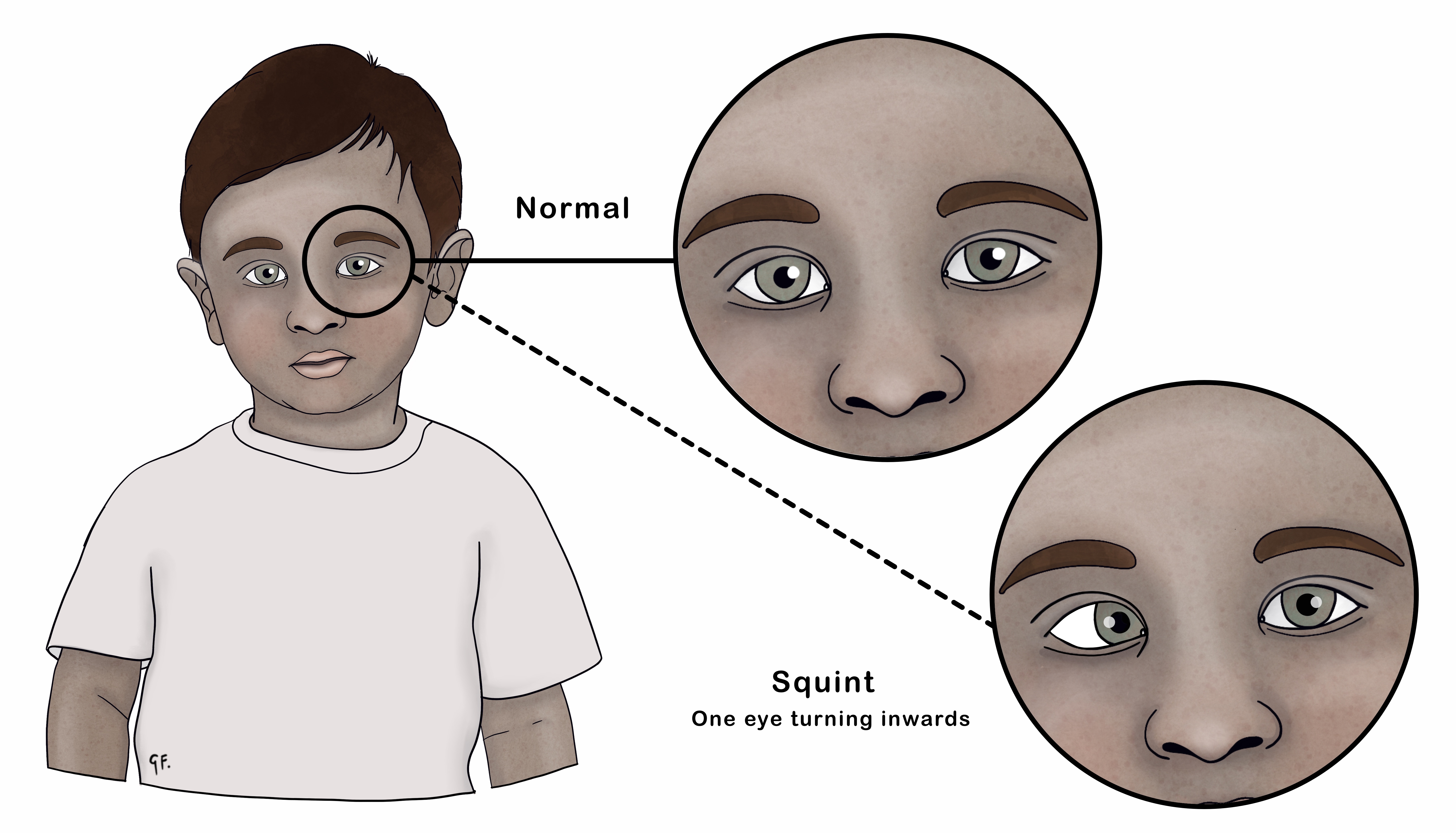 Squint | KidsHealth NZ