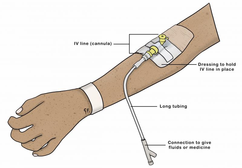 IV Line (Cannula) | KidsHealth NZ