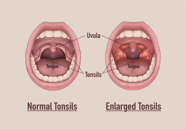 Swollen Tonsils Vs Normal