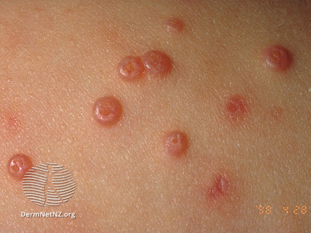 Molluscum Contagiosum | KidsHealth NZ