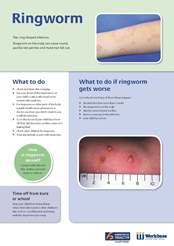 Ringworm | KidsHealth NZ